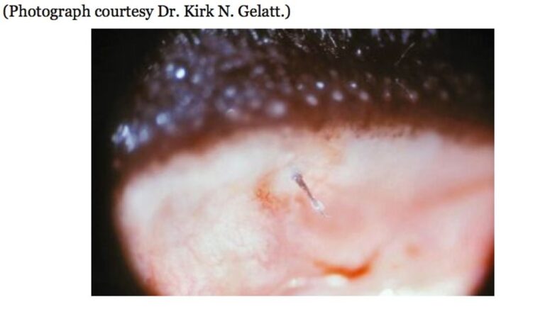 Trichiasis, Ectopic Cilia, and Distichia: T.E.D. Talk on Eyelash ...